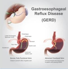 Gastrointestinal Motility & GERD Therapy Laboratory | Saint Peter's ...